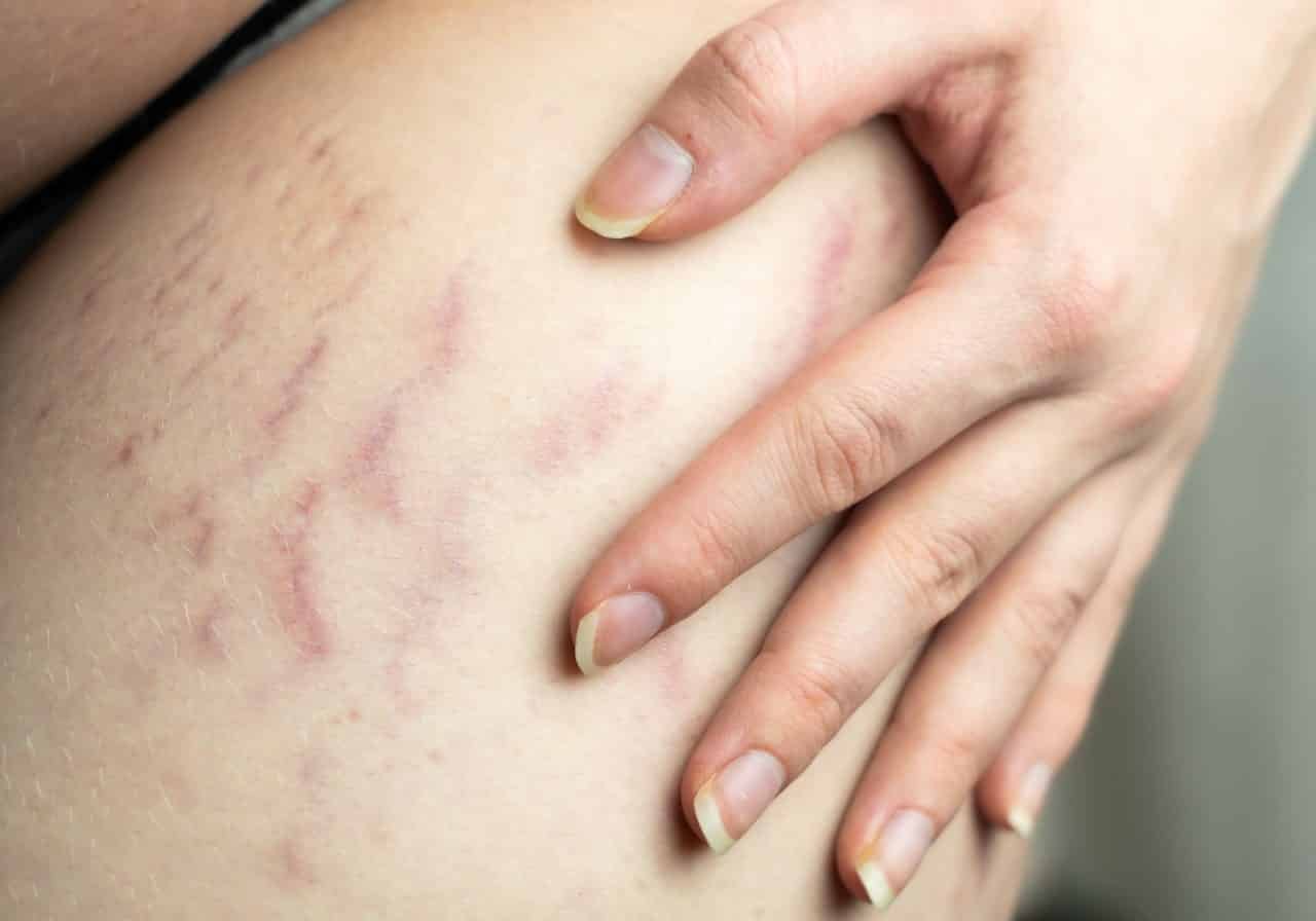 Vergetures, comment les faire disparaître ? - Centre Thetys